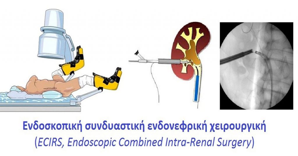 Υπηρεσίες - Ιωάννης Μπουζαλάς Χειρουργός Ουρολόγος Ανδρολόγος