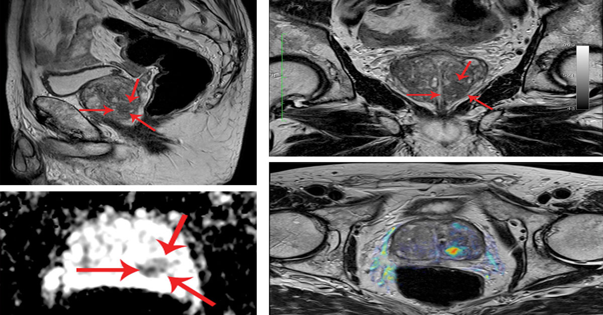Πολυπαραμετρική Μαγνητική Τομογραφία Προστάτη (mpΜRI, multiparametric ...