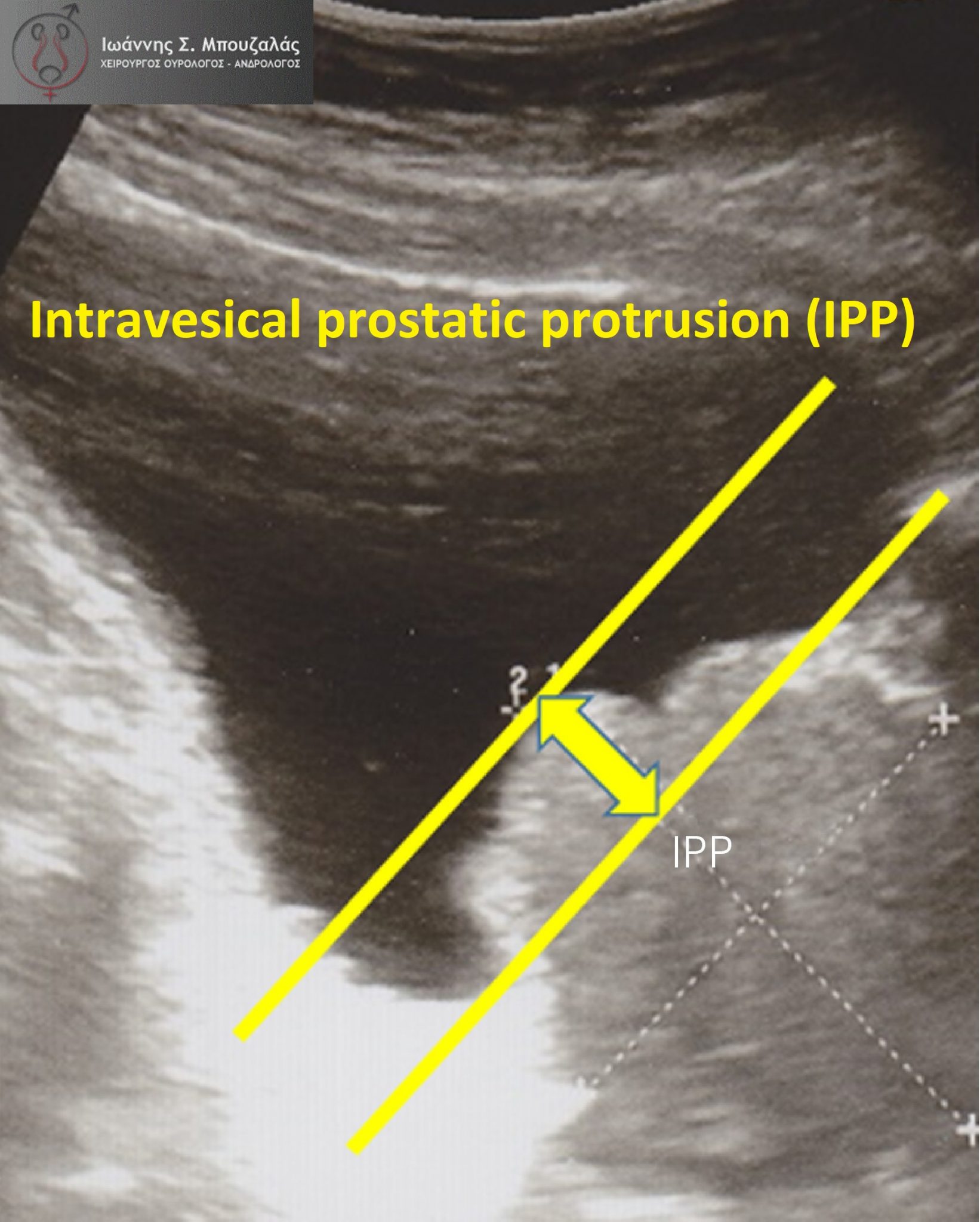 Υπερηχογραφία κατώτερου ουροποιητικού συστήματος - Υπερηχογραφική ...