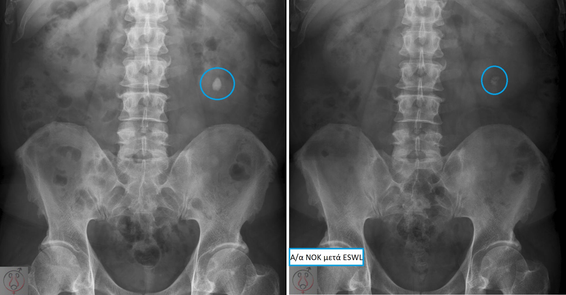 Εξωσωματική Λιθοτριψία (ESWL, extracorporeal shock wave lithotripsy ...