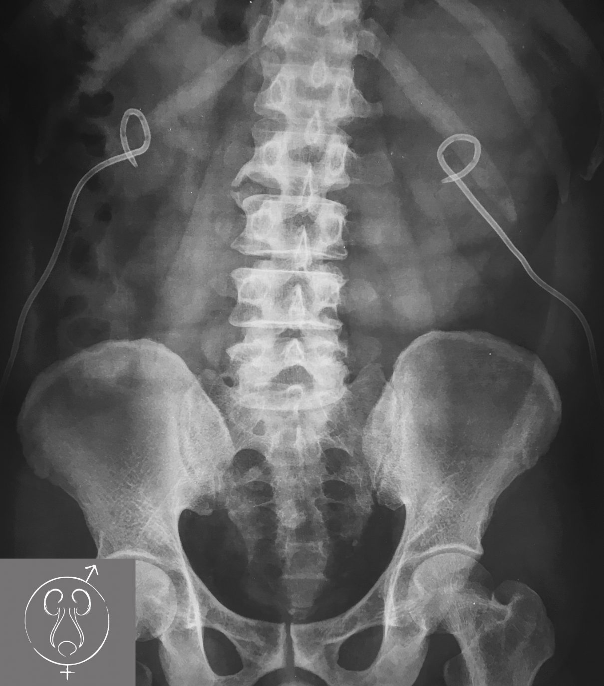 Διαδερμική Νεφροστομία - Ιωάννης Μπουζαλάς Χειρουργός Ουρολόγος Ανδρολόγος