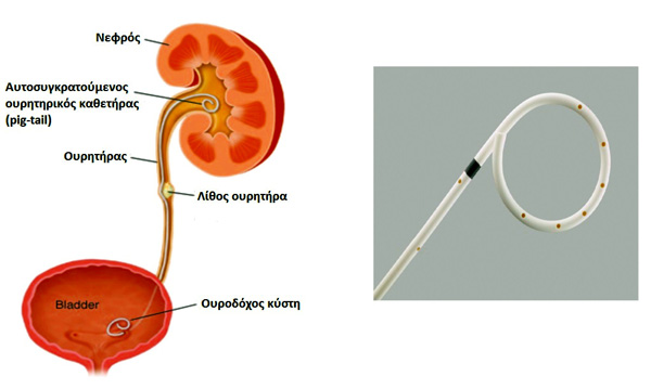 Τι είναι τα ουρητηρικά stents και πότε χρησιμοποιούνται; - Ιωάννης ...
