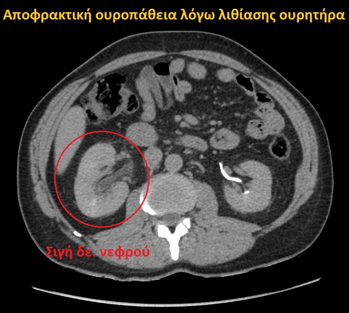 Αποφρακτική Ουροπάθεια - Ιωάννης Μπουζαλάς Χειρουργός Ουρολόγος Ανδρολόγος
