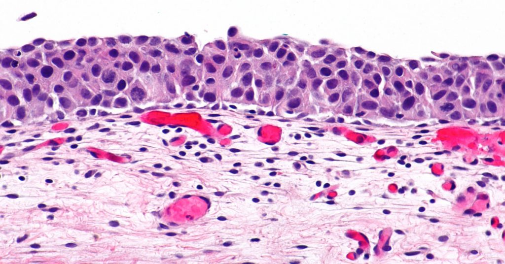 Θεραπεία καρκίνου ουροδόχου κύστης - Ιωάννης Μπουζαλάς Χειρουργός ...